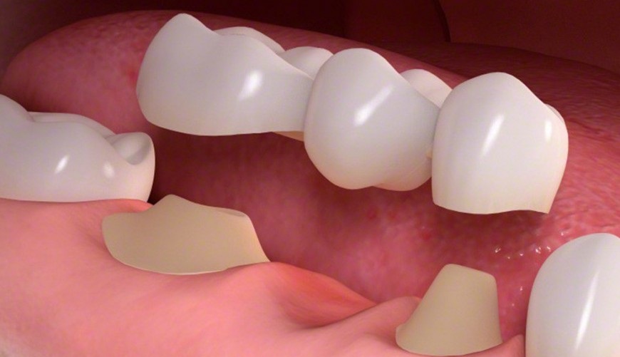 FIXED PROSTHODONTIC COURSE